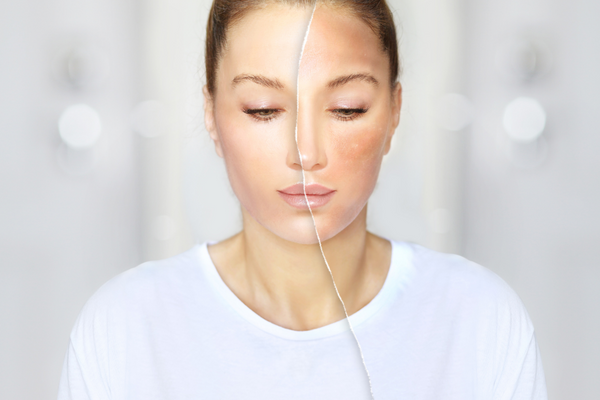 Hyperpigmentation: Understanding the Causes and Best Skincare Solution ...