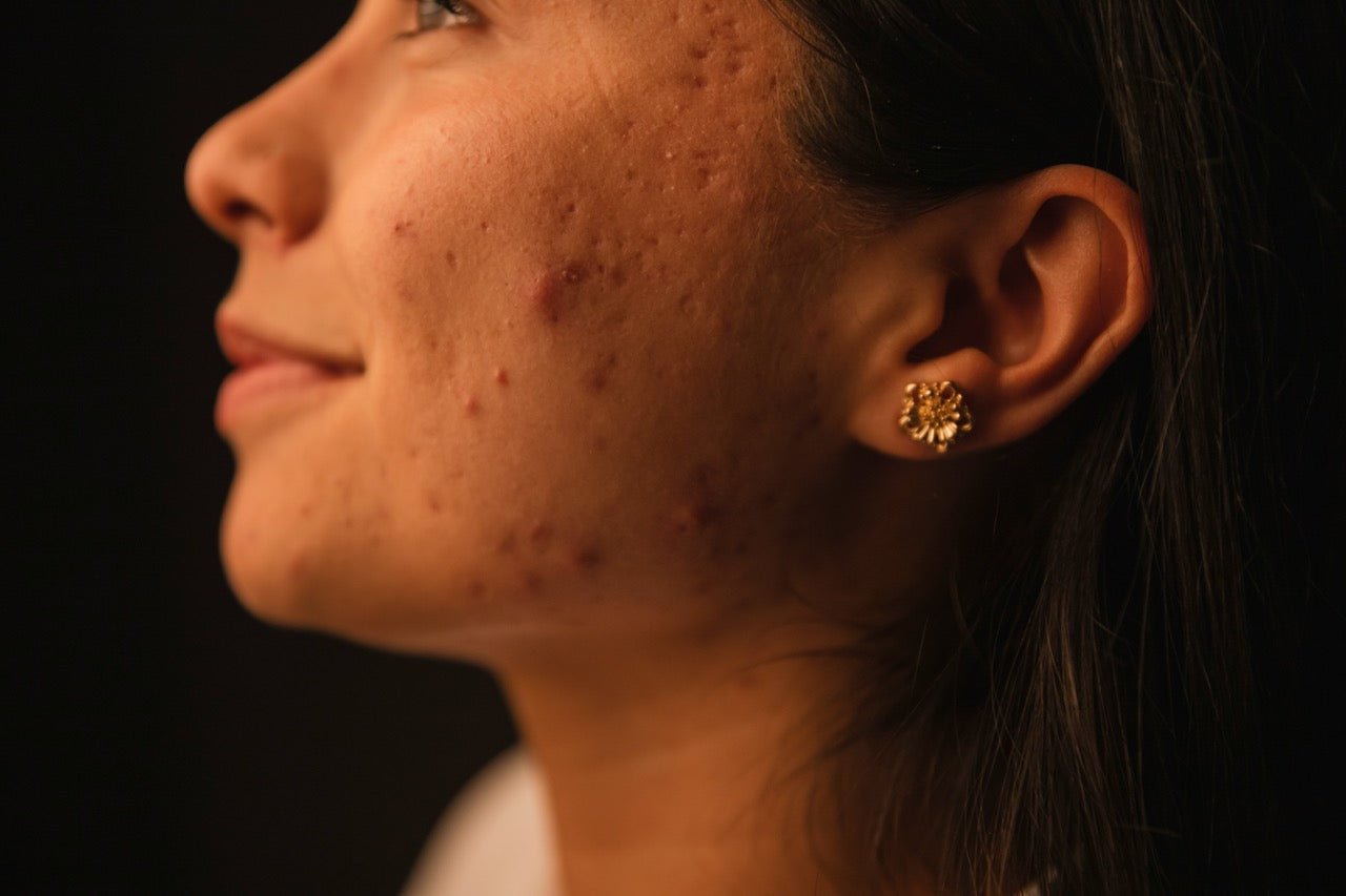 Why You Really Shouldn’t Pop Your Pimples (But What To Do If You Just ...